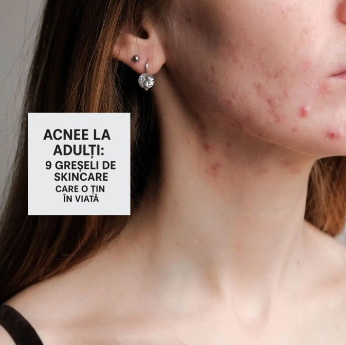 Acnee la adulți: 9 greșeli de skincare care o țin în viață | MakeupShop.ro